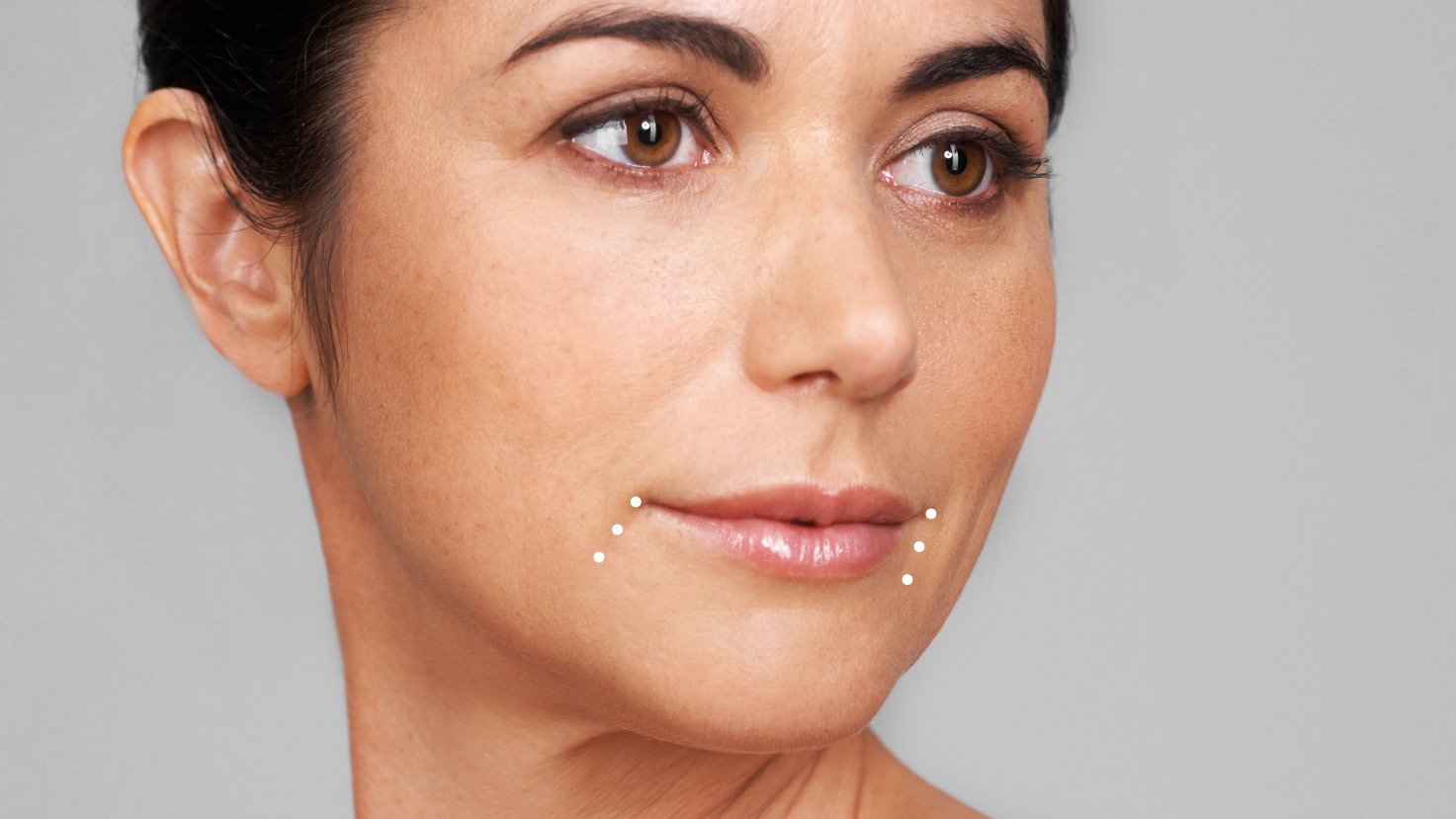 Nedadvendte mundvige | Få smilet tilbage med Juvederm